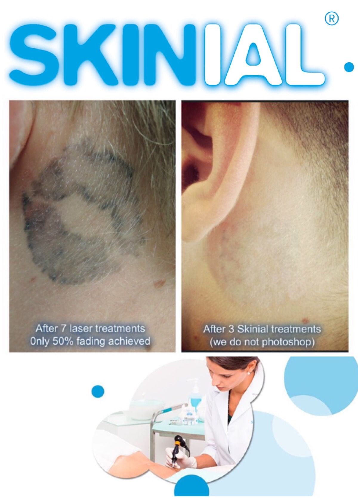 DERMAOZ utilise la nouvelle méthode SKINIAL pour enlever ou corriger ...